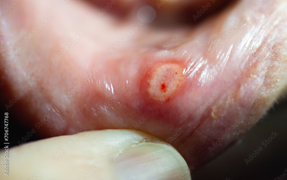 Painful close up of a mouth canker sore ulcer with a shallow depth of ...
