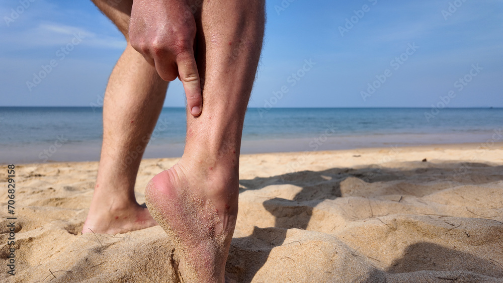 Person showing beach fly bites, beach flea bites on a leg on a sandy ...