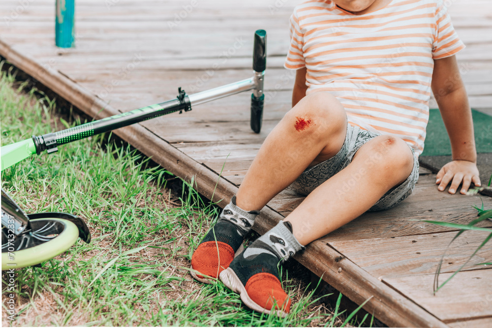 A close-up of a child's leg injury. The child injured his knee when he ...