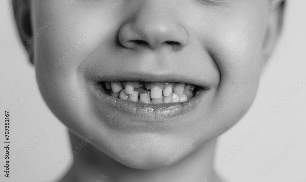 cute preschool boy with one milk teeth missing.smiling child close up ...