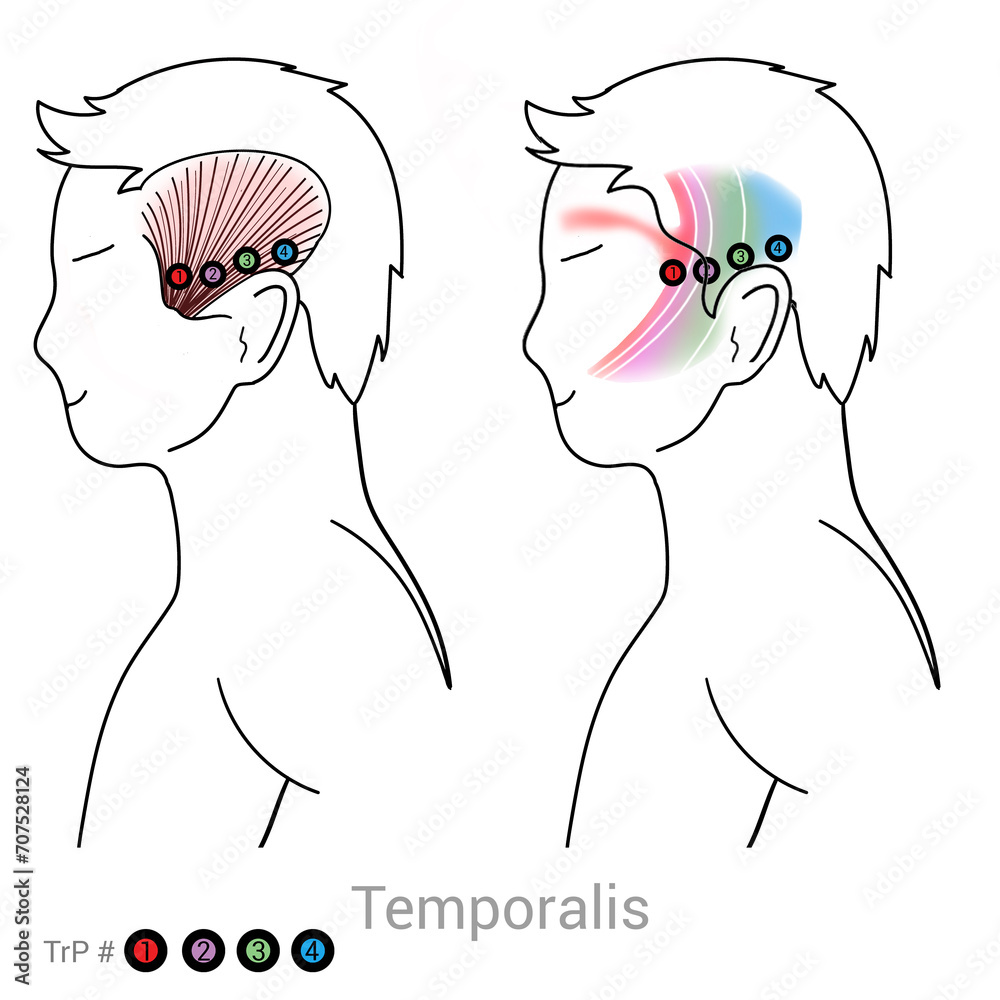 Temporalis: Myofascial trigger points and associated pain locations ...