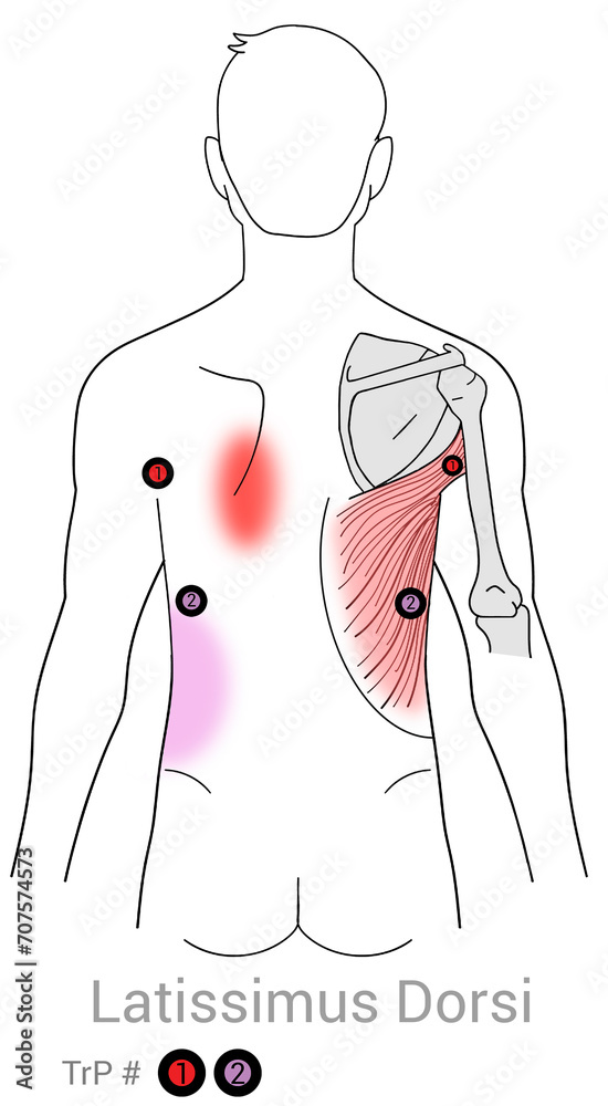 Latissimus Dorsi: Myofascial trigger points and associated pain ...