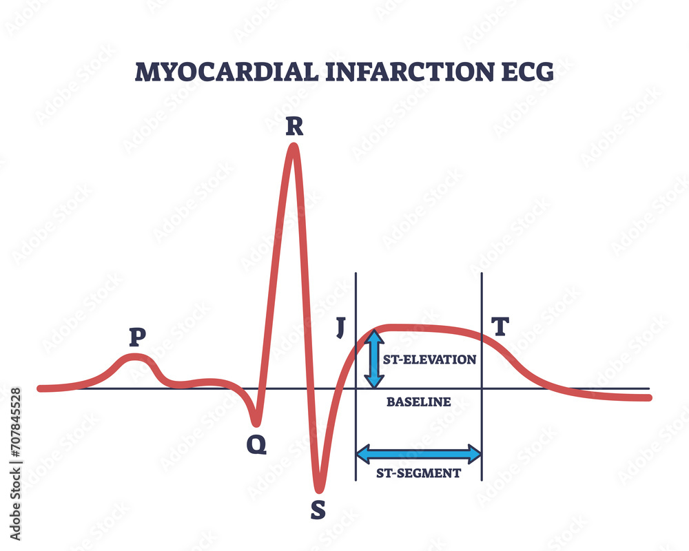 Vecteur Stock Myocardial infraction ECG with abnormal ST segment ...