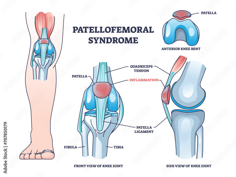 Patellofemoral pain syndrome as anatomical knee condition outline ...