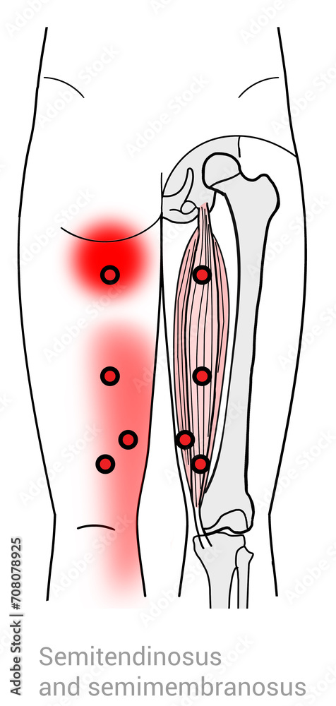 Semitendinosus and Semimembranosus : Hamstrings, Myofascial trigger ...