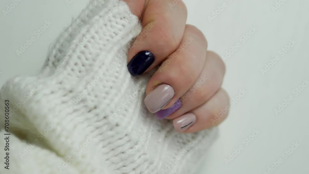 The finger is swollen from inflammation due to infection caused by a ...