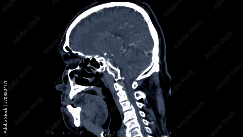 CT scan of the brain sagittal view for diagnosis brain tumor,stroke ...