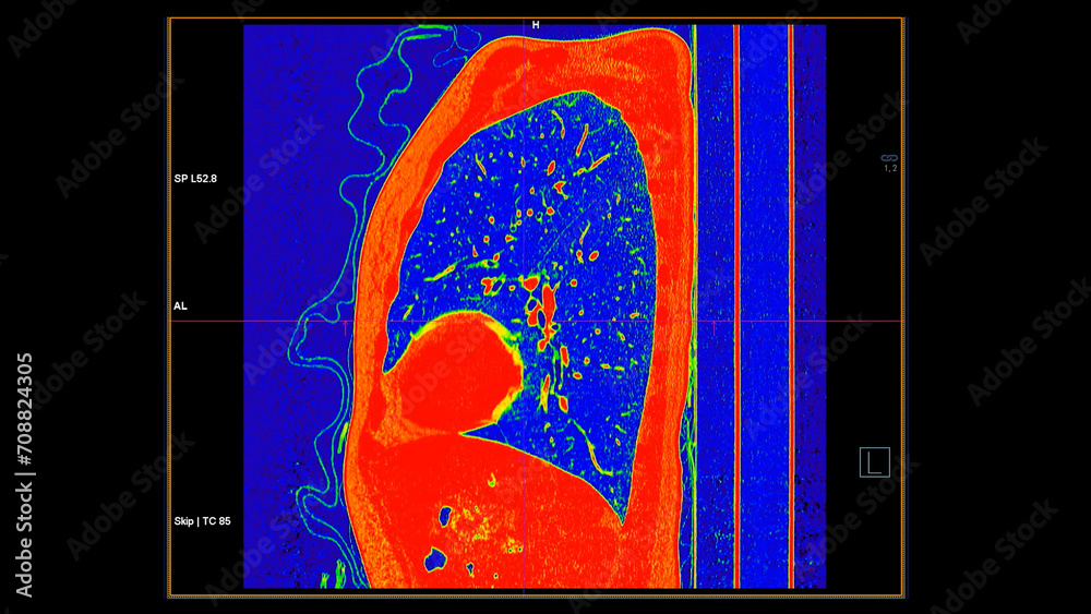 CT scan of Chest sagittal view in color mode for diagnostic Pulmonary ...