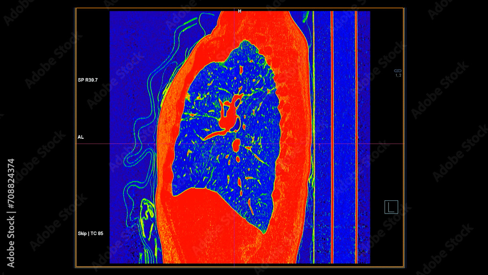 CT scan of Chest sagittal view in color mode for diagnostic Pulmonary embolism (PE) , lung ...