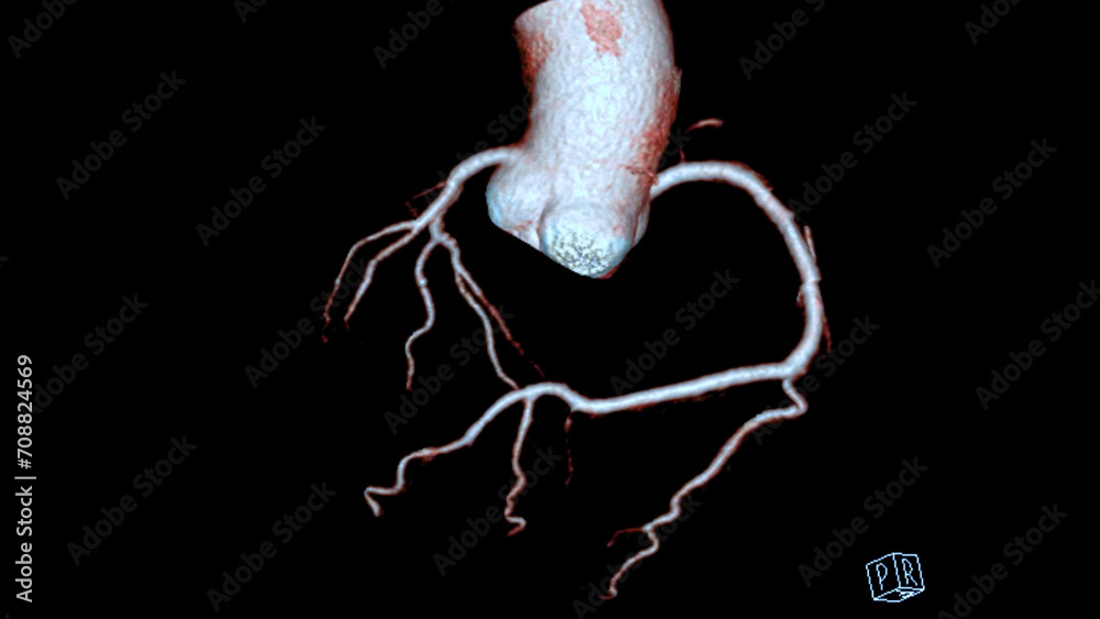 CTA coronary artery 3D rendering is a diagnostic imaging technique ...