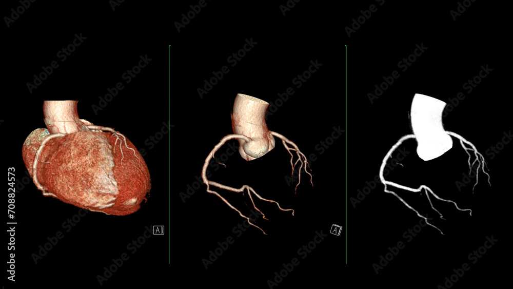 CTA coronary artery 3D rendering is a diagnostic imaging technique ...