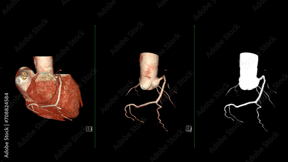 CTA coronary artery 3D rendering is a diagnostic imaging technique ...