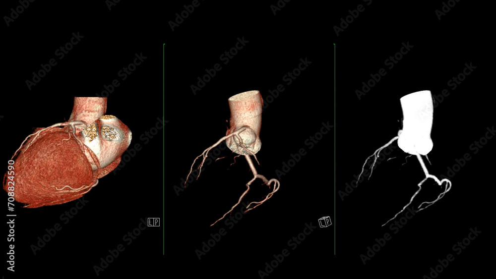 CTA coronary artery 3D rendering is a diagnostic imaging technique ...