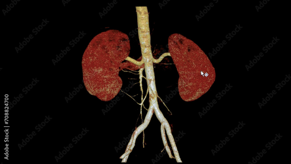CTA Renal artery 3D is a medical imaging procedure using CT scans to ...