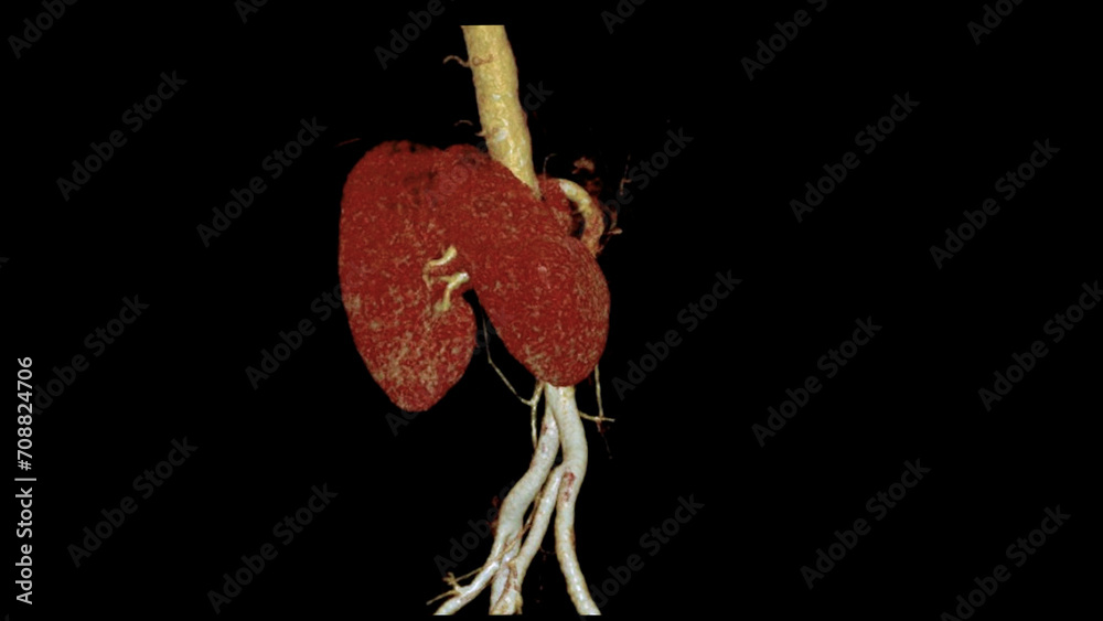 CTA Renal artery 3D is a medical imaging procedure using CT scans to ...