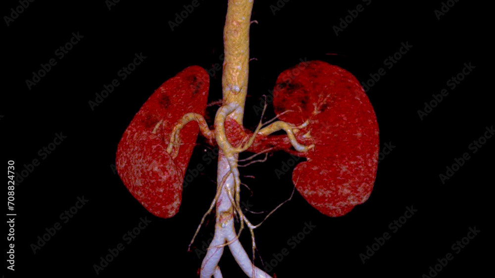 CTA Renal artery 3D is a medical imaging procedure using CT scans to ...