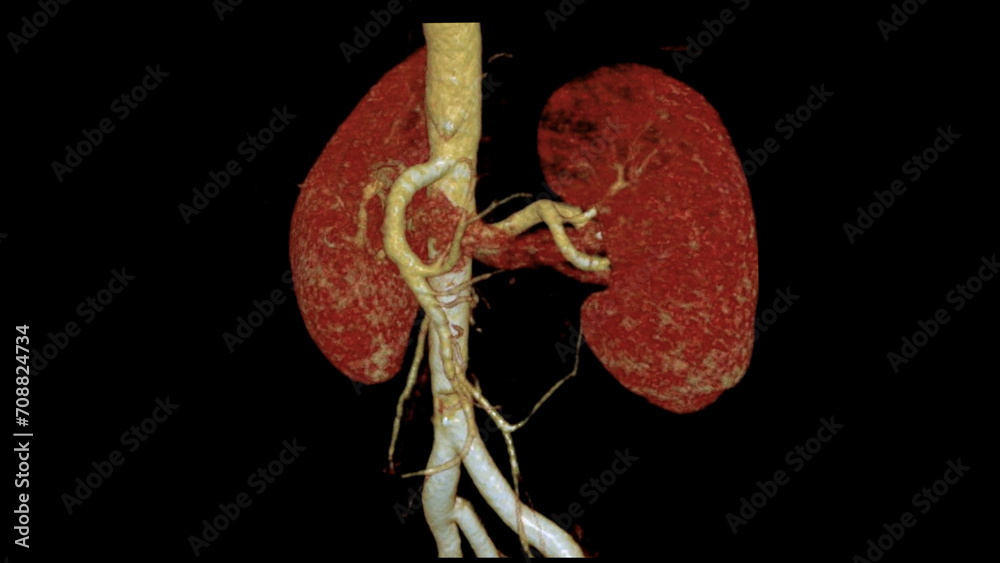CTA Renal artery 3D is a medical imaging procedure using CT scans to ...