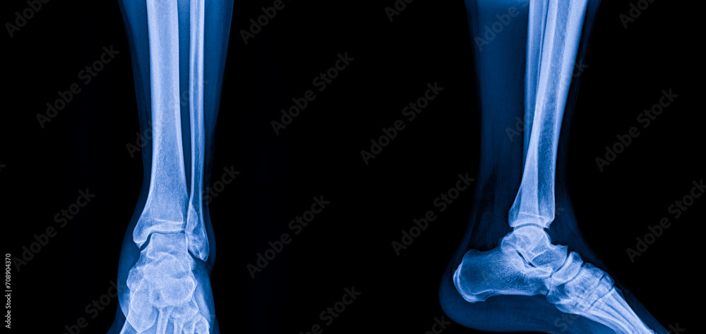 Plain x-ray AP Lateral views of ankle showing syndesmotic ankle sprain ...