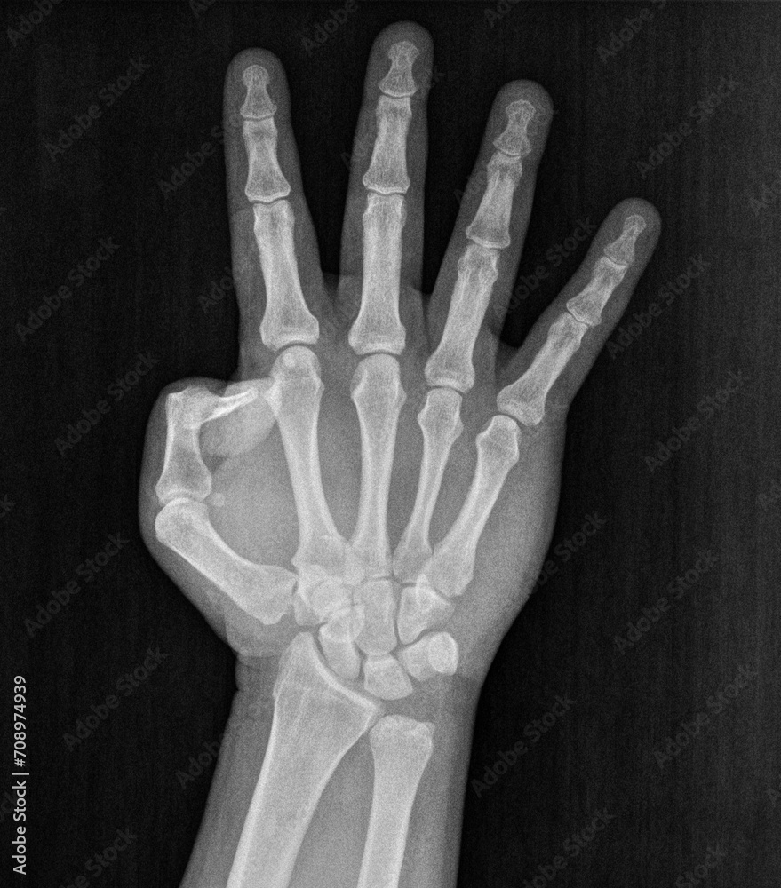 Film xray x-ray or radiograph of a hand and fingers showing the number ...