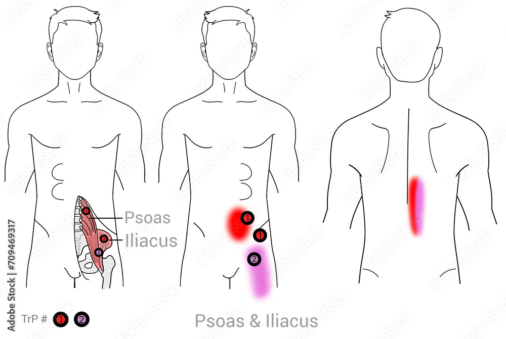 Psoas & Iliacus: Myofascial trigger points and associated pain ...