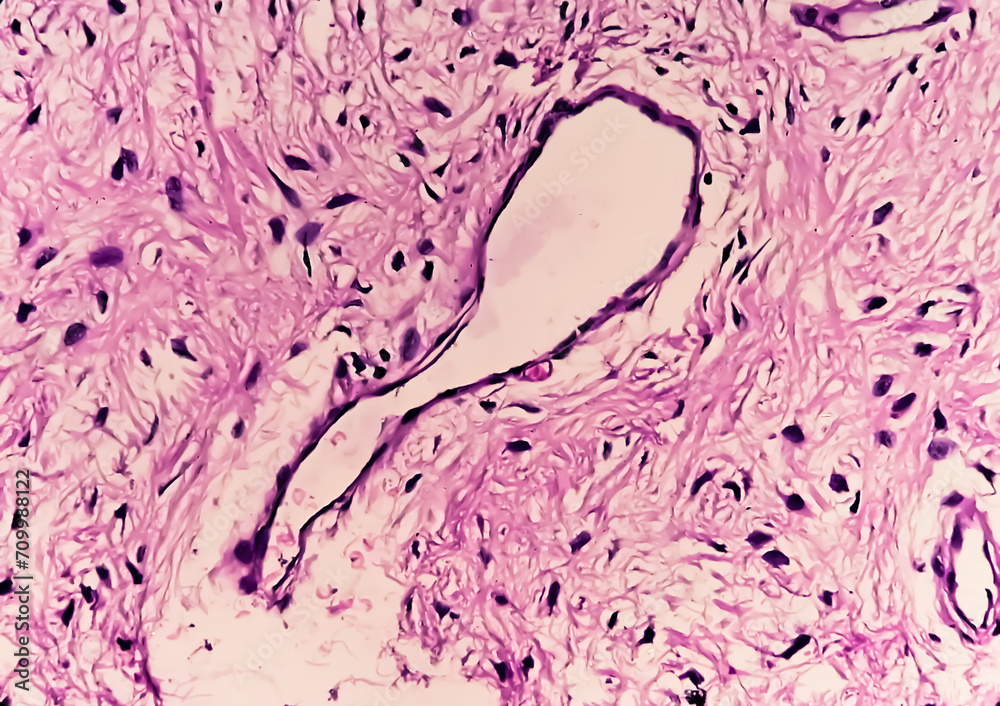 Leg tissue biopsy: Photomicrographic image showing Fibromyxoma ...