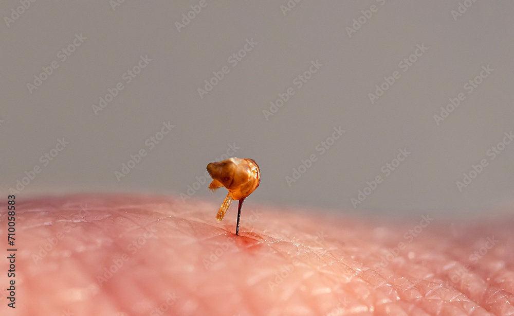 bee sting close-up stuck into human skin after being bitten by a ...