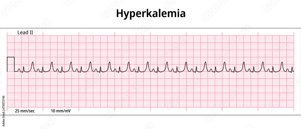 ECG Hyperkalemia - Hyperkalaemia - 8 Second ECG Paper ...
