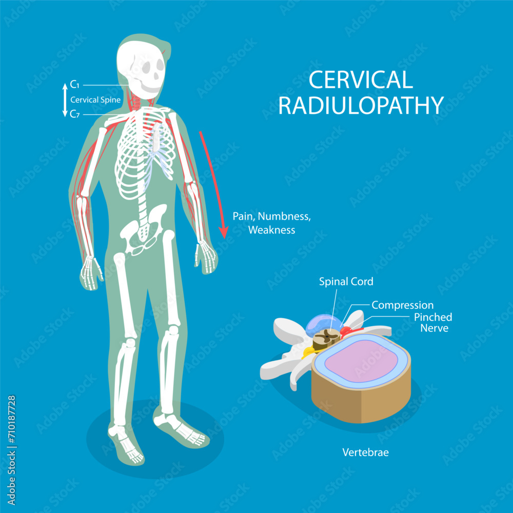 3D Isometric Flat Vector Illustration of Cervical Radiulopathy ...