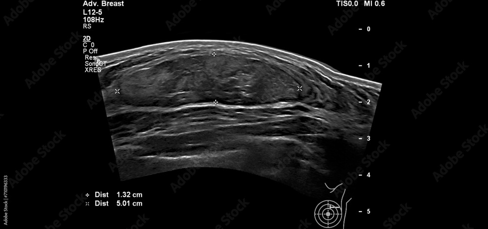 Image of breast ultrasound for cancer checks in women with breast mass ...