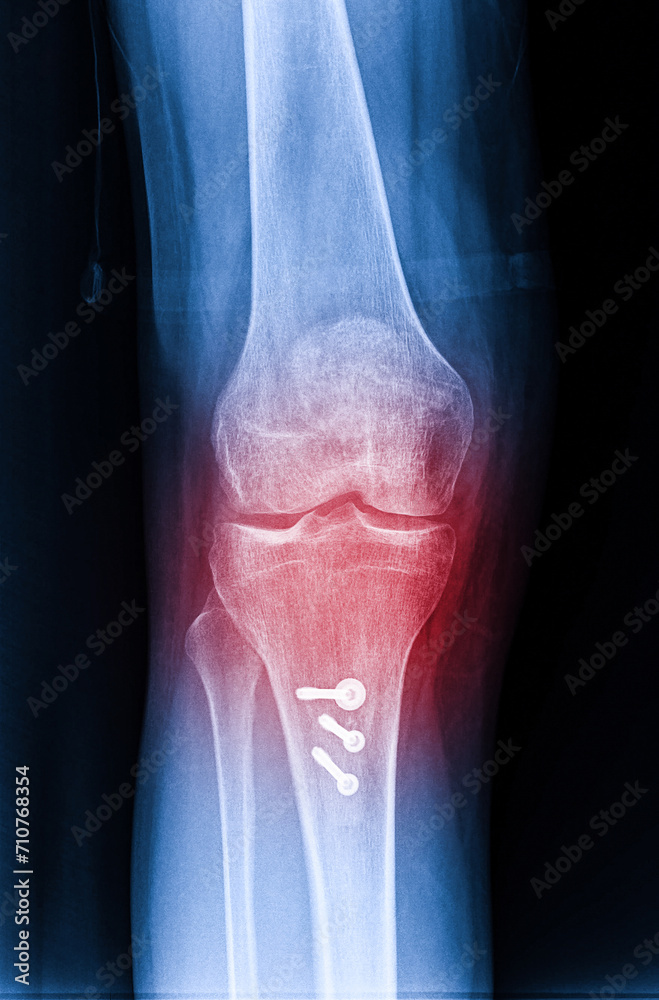X-ray Knee Joint Fracture proximal tibia and Post fix fracture proximal ...