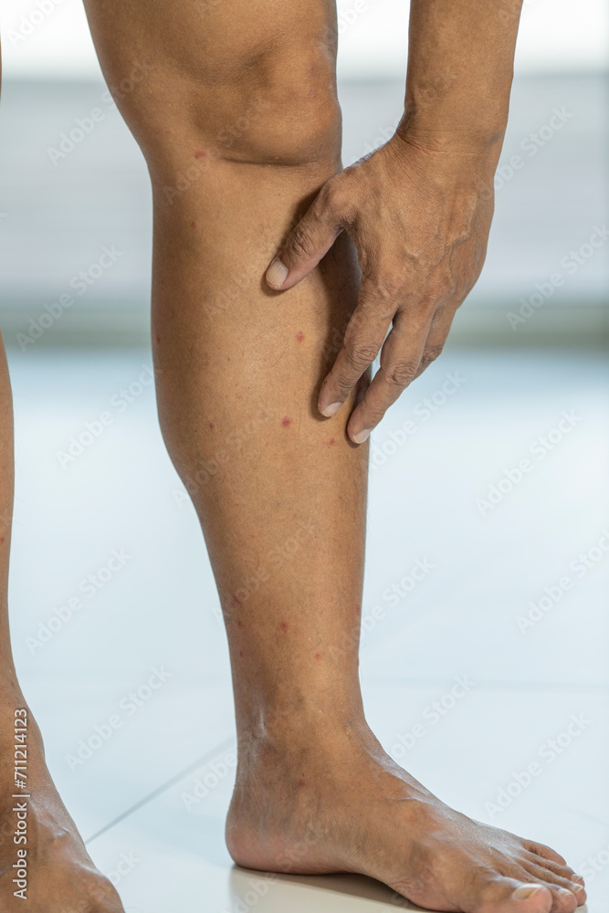 Midge bite marks on a male legs,Feet and legs of a man with midge bites ...