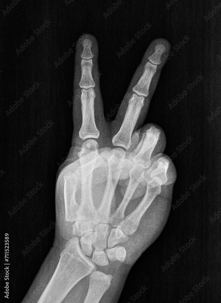 Film xray x-ray or radiograph of a hand and fingers showing the peace ...