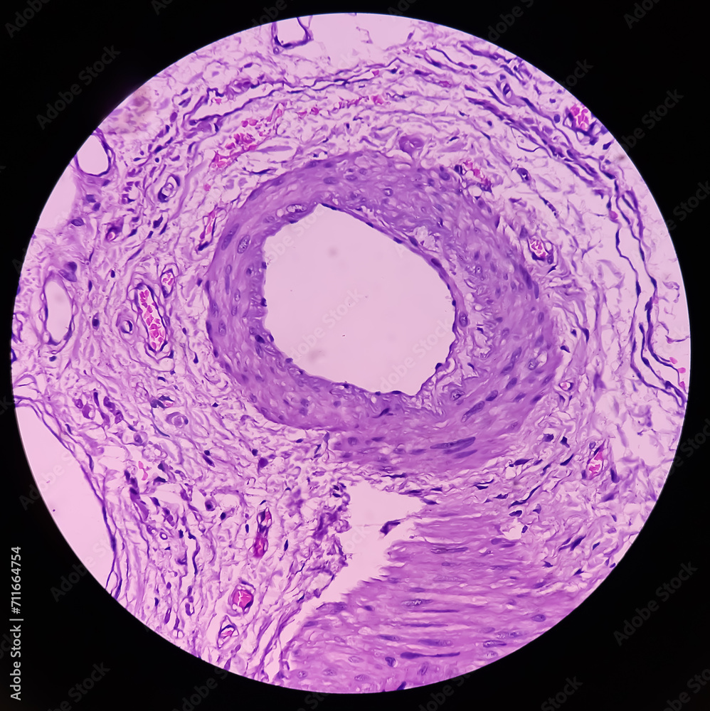 Lipoma on loin, benign growth of fatty tissue, benign neoplasm ...