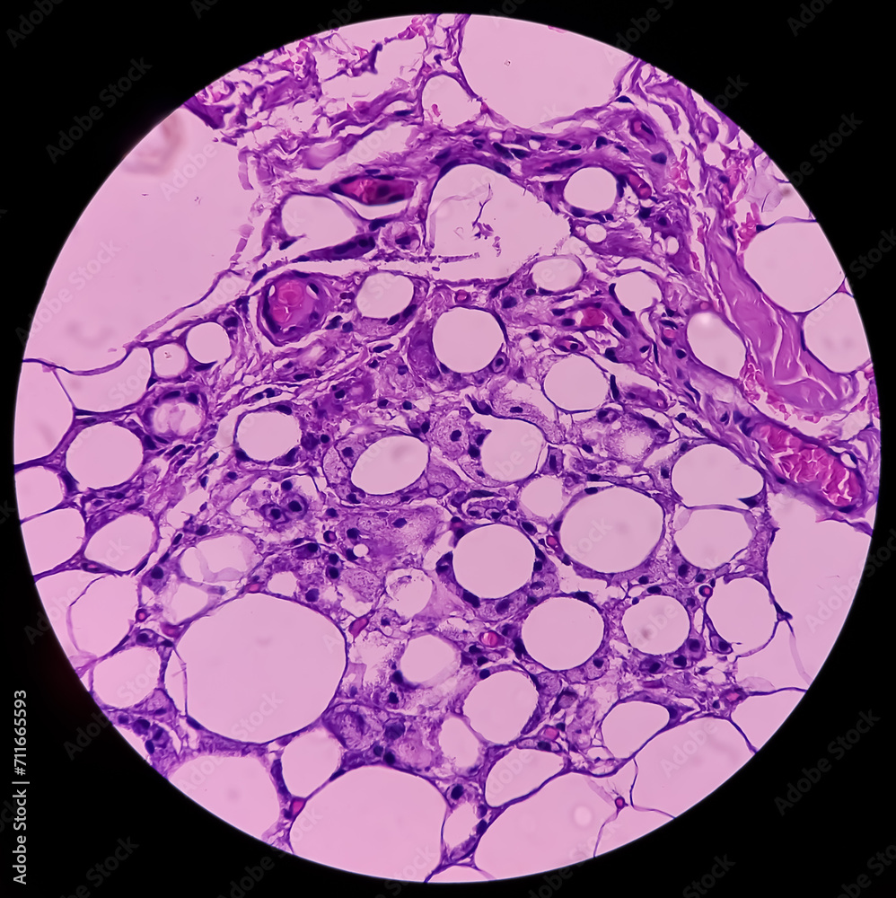 Lipoma on cubital fossa, benign growth of fatty tissue, benign neoplasm ...