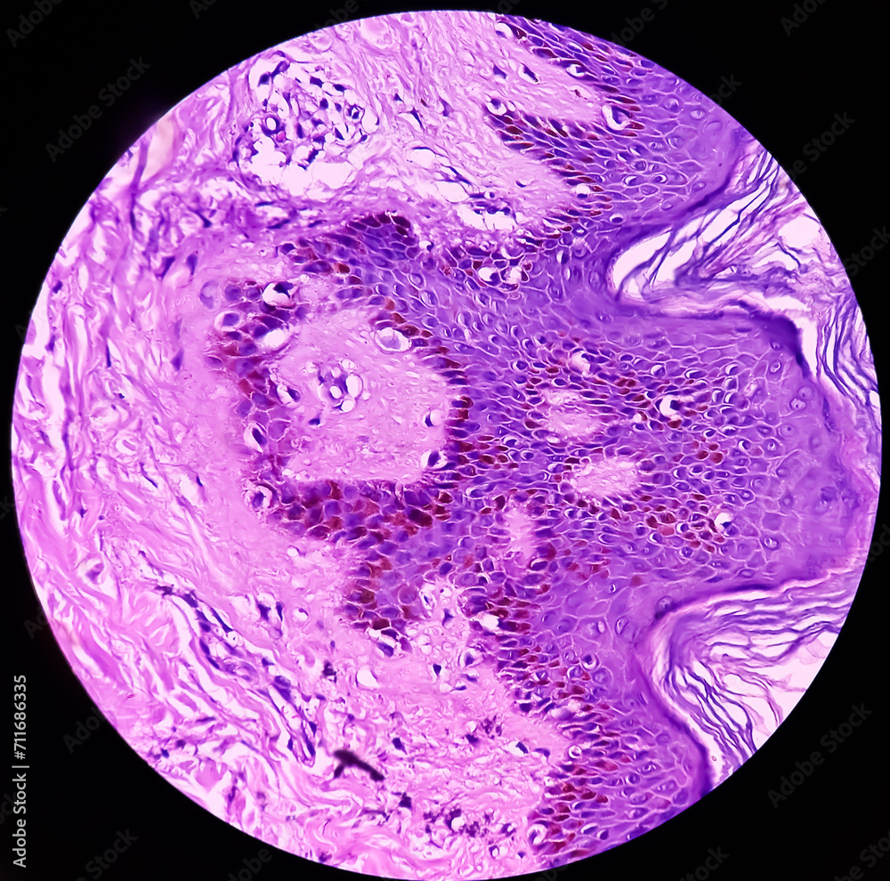 Lipoma on loin, benign growth of fatty tissue, benign neoplasm ...