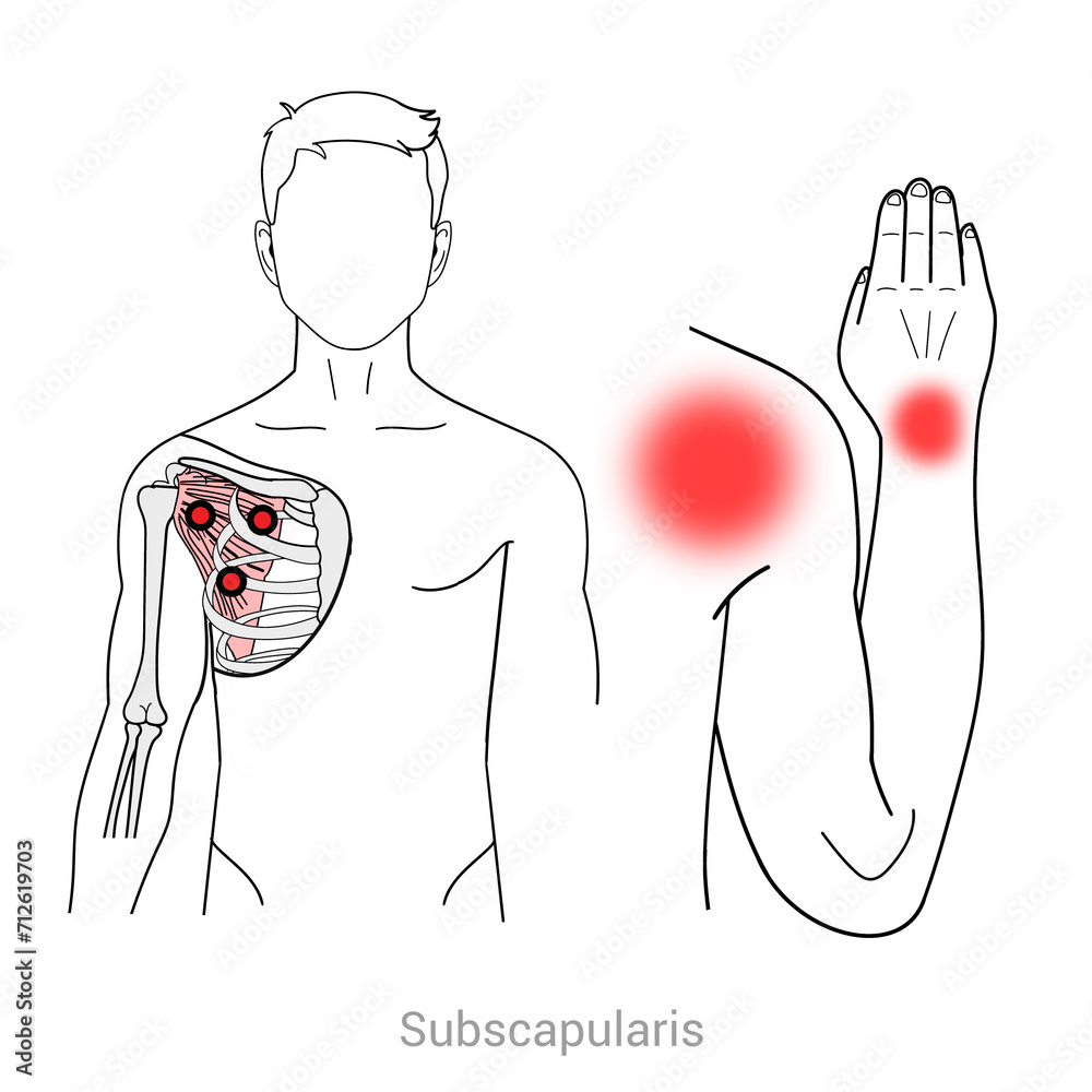 Subscapularis: Myofascial trigger points and associated pain locations ...