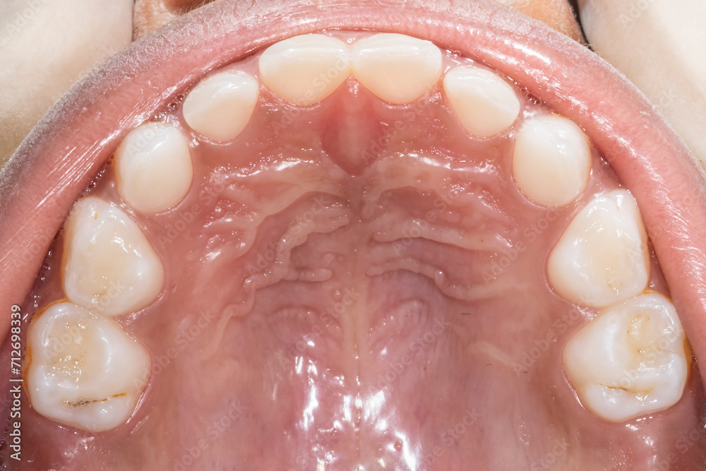Upper maxillary arch occlusal view of a eight year old child dentition ...