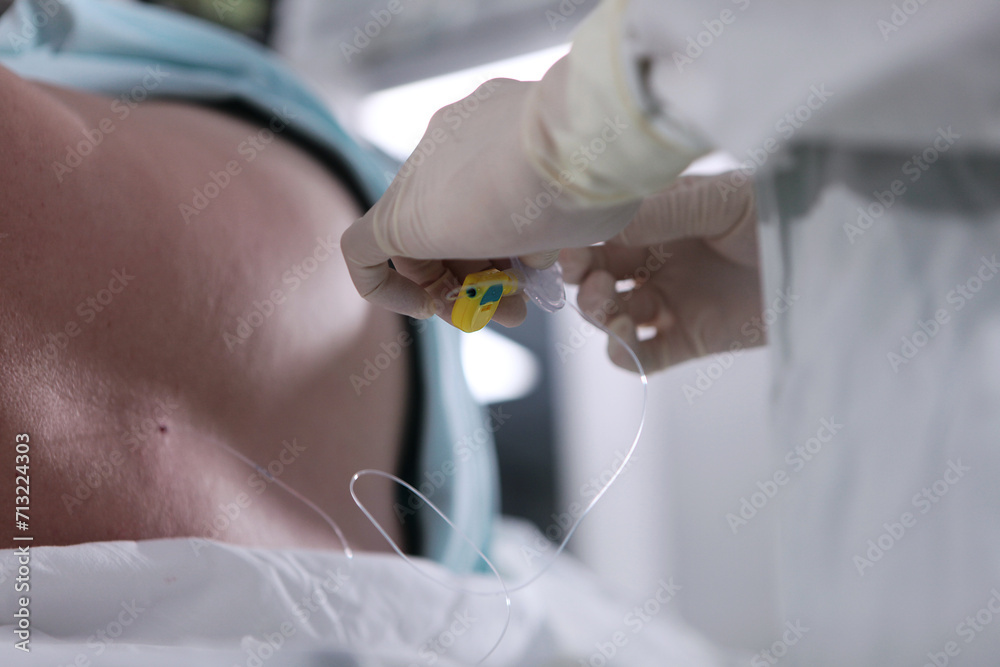 Epidural anesthesia in preparation for vascular surgery. Injections of ...