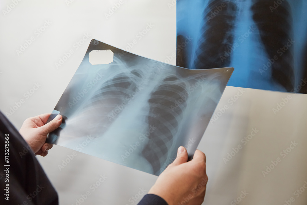 X-ray images of lungs in hands and on the stand. Diagnosis, lung ...