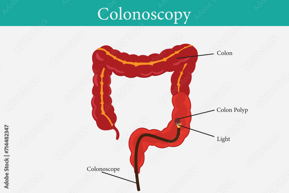 Colonoscopy treatment, familial adenomatous polyposis. Examination and ...
