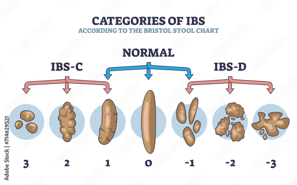 Categories of IBS stages according to bristol stool chart outline ...