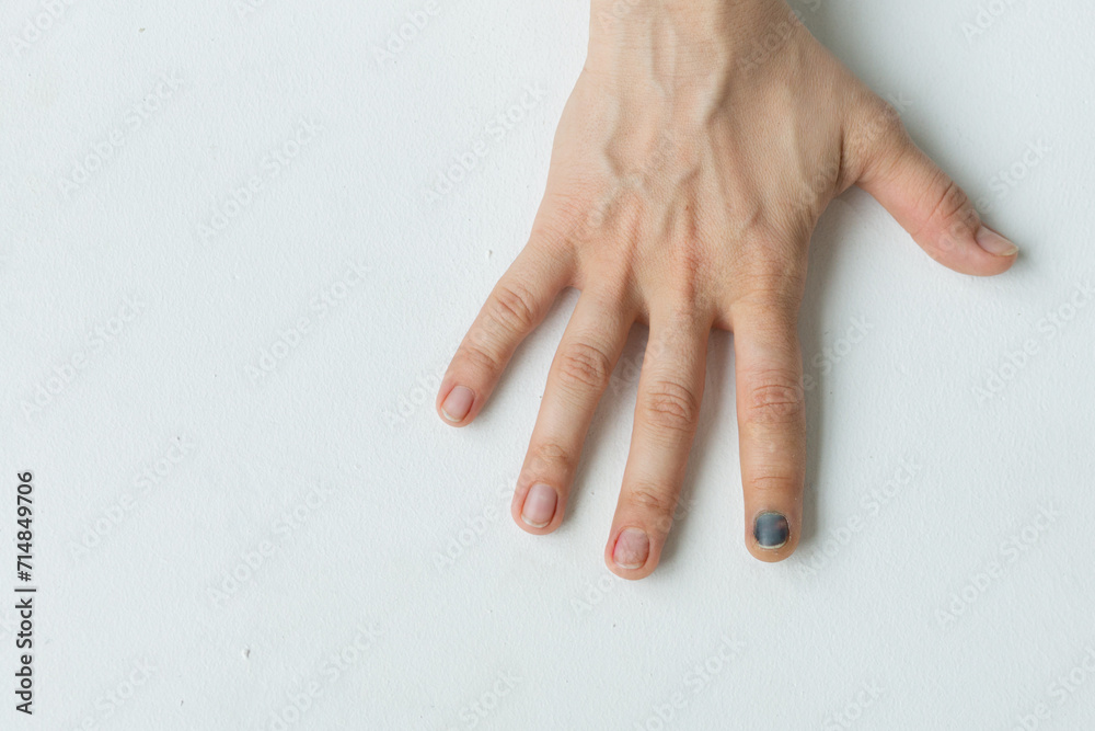 Hematoma on the index finger of a woman’s hand, formed as a result of a ...