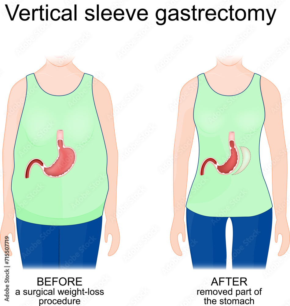 Vertical sleeve gastrectomy. Human body before and after surgical ...