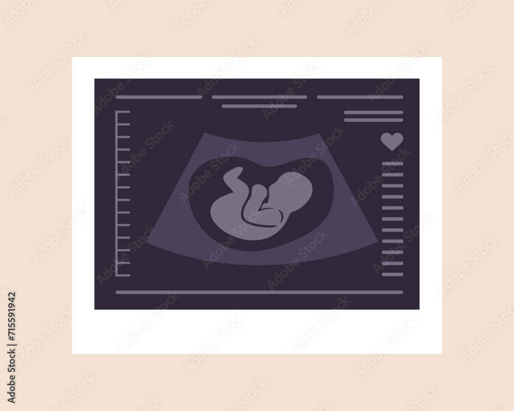 Ultrasound of baby. Embryo in womb. Pregnancy screening. Baby health ...
