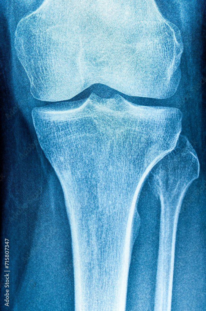 x-ray image of knee AP view for detect Osteoarthritis Knee Stock Photo ...