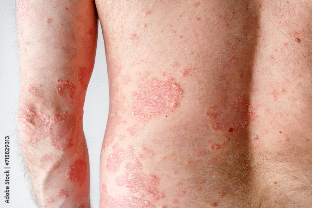 Papules of chronic psoriasis vulgaris on male arm and back body on ...