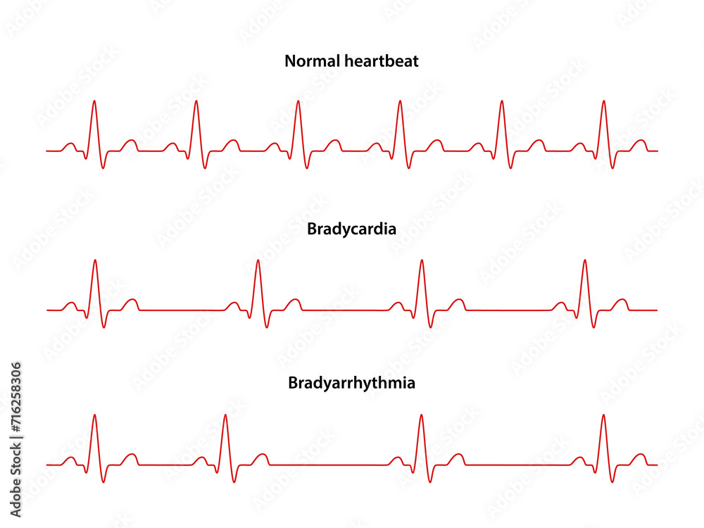 Diagram of normal rhythm, Bradyarrhythmia and Bradycardia for a human ...