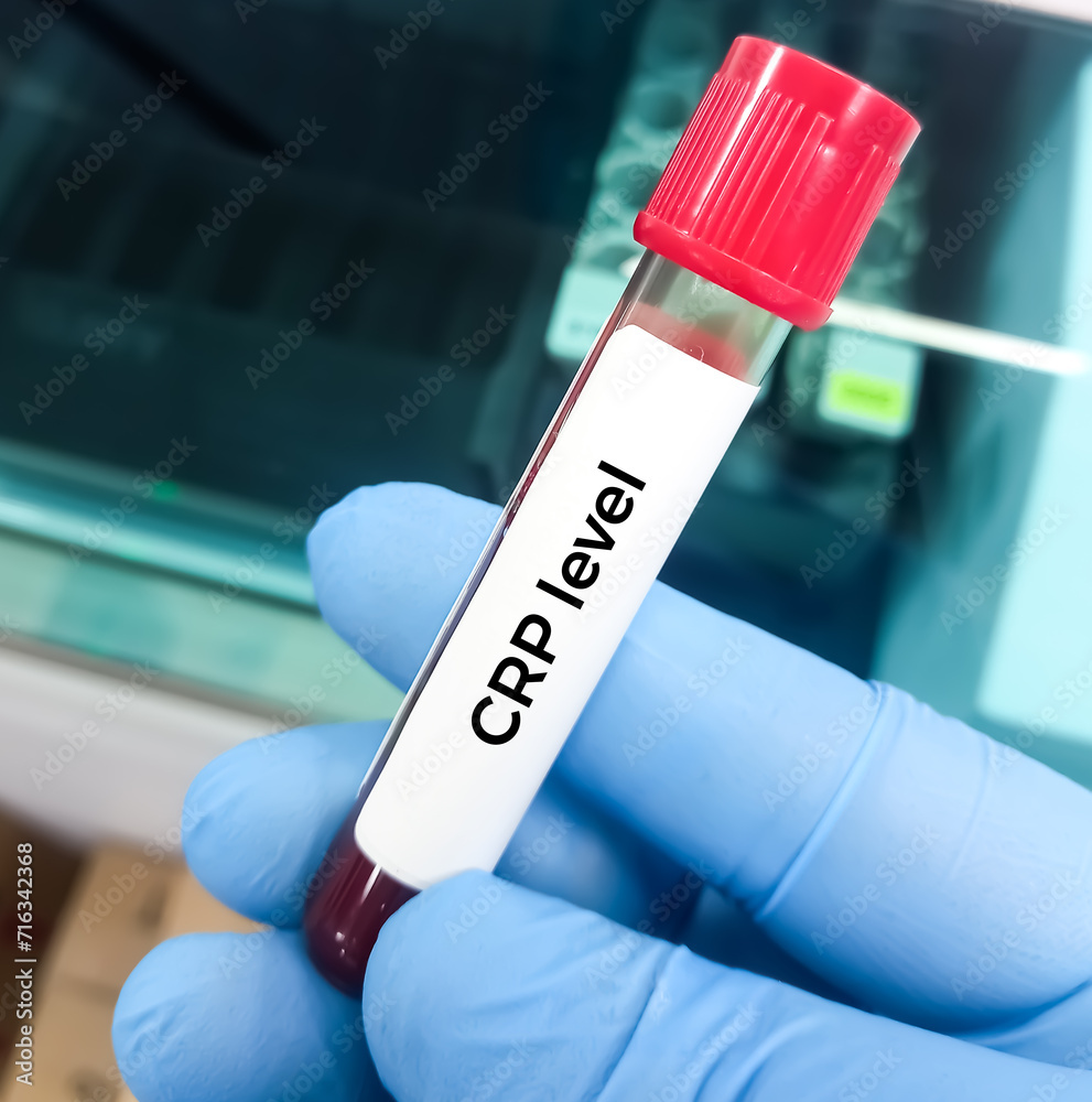 Blood sample for CRP(C-reactive protein) test used to identify ...