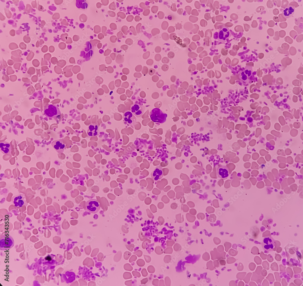 Essential thrombocytosis blood smear showing abnormal high volume of ...