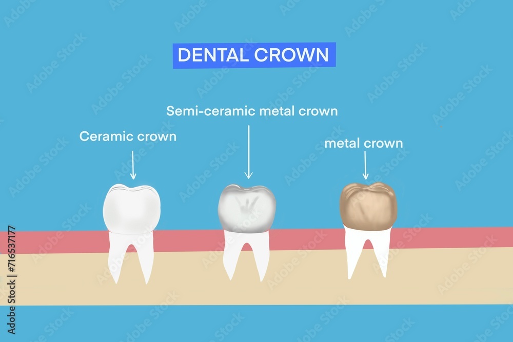 anatomy of the teeth, dental crown, illustration Stock Illustration ...
